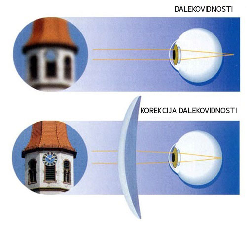 Dalekovidnost (hypermetropia)