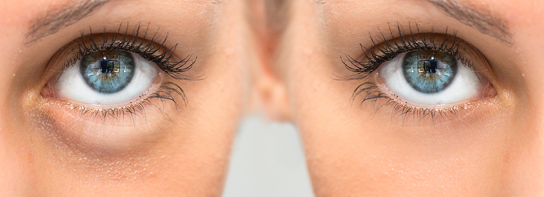 Podočnjaci – uzroci i posljedice